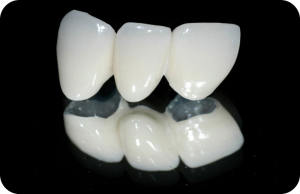 Bridge dentaire Barcelone 1050€ - Clinique dentaire Espagne - EL CEDRO